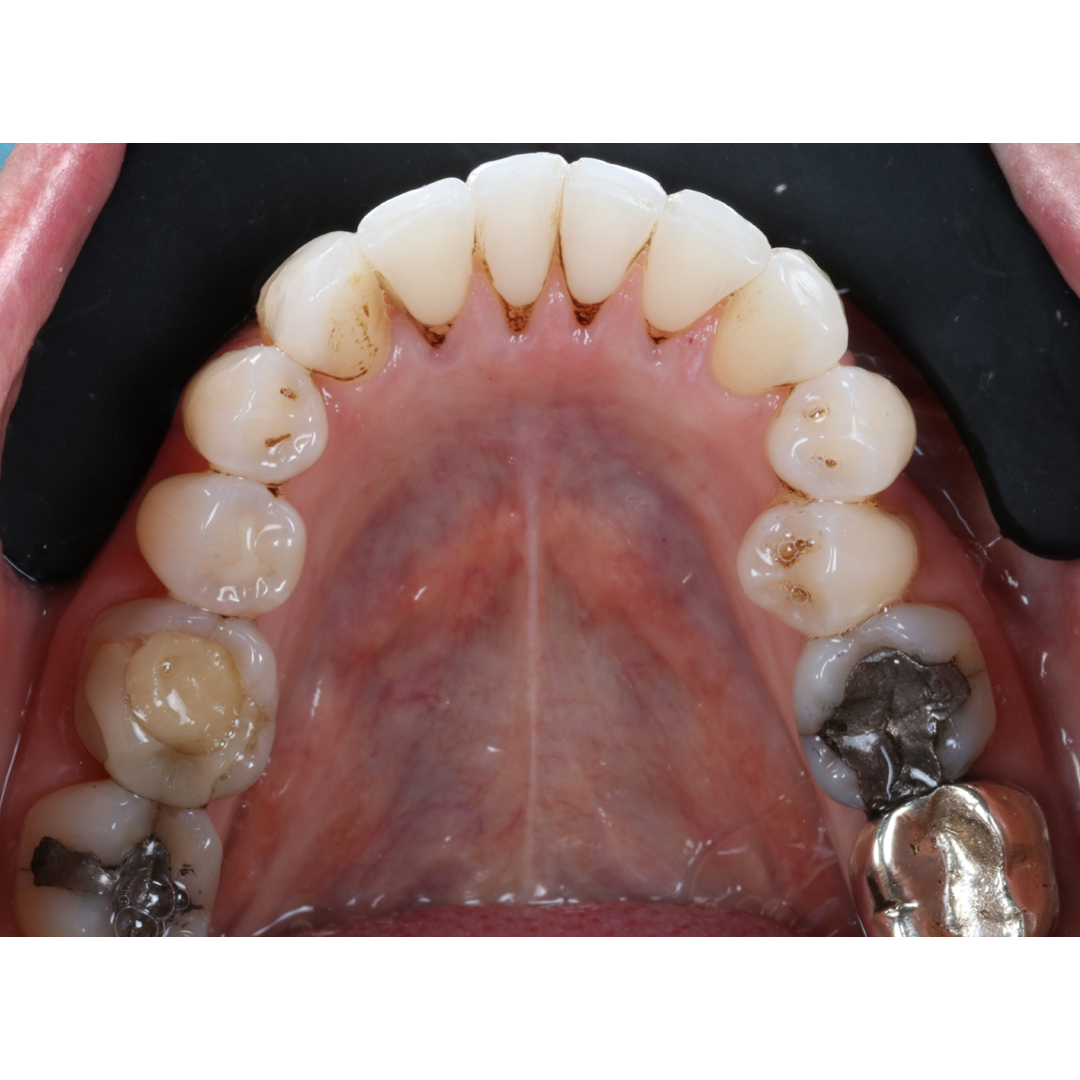 Invisalign Case 1 - Private Dentist in Matlock, Derbyshire Dales ...